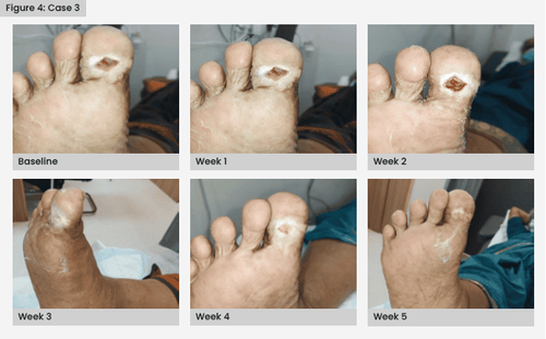 Autologous platelet-rich fibrin matrix in the treatment of diabetic ...