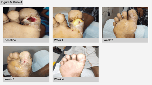 Autologous platelet-rich fibrin matrix in the treatment of diabetic ...