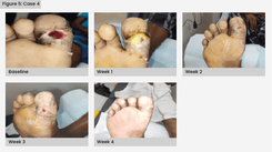 Autologous platelet-rich fibrin matrix in the treatment of diabetic ...